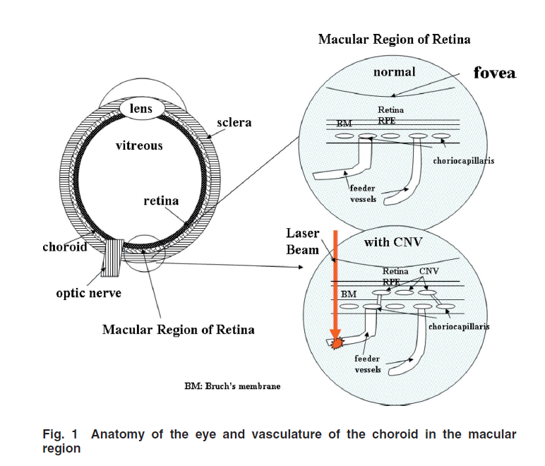 Laser coagulation of choroidal feeder vessels for AMD patients ...